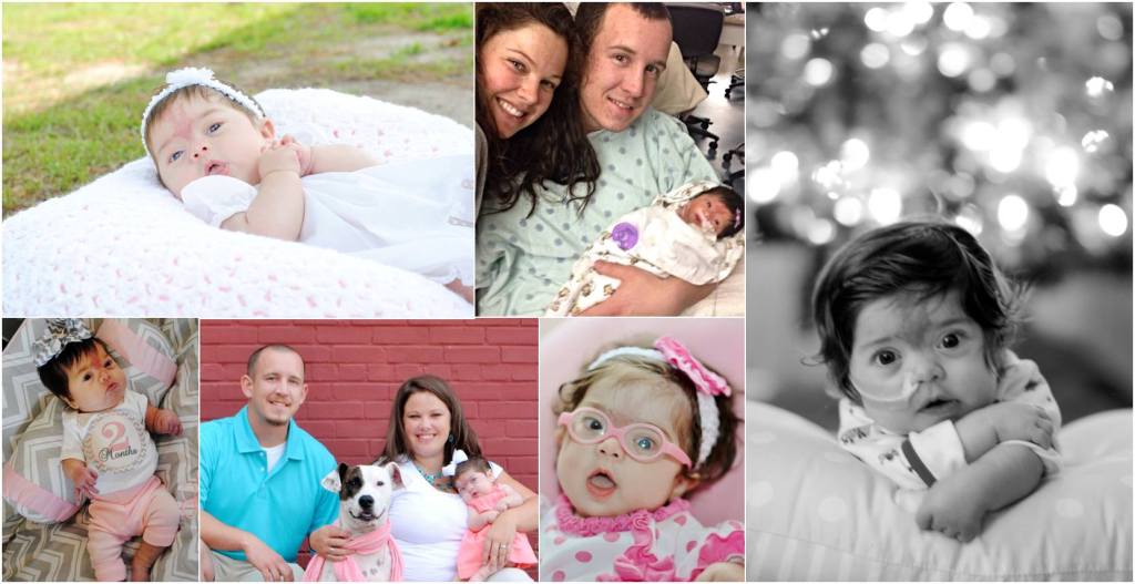 Talynn – Bohring-Opitz Syndrome/ASXL1