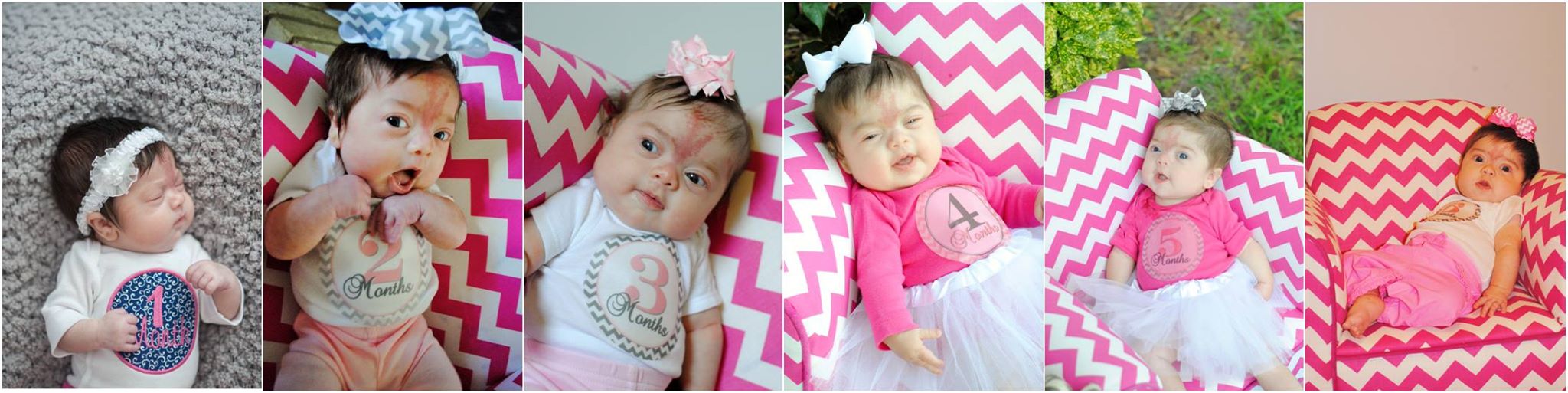 Talynn – Bohring-Opitz Syndrome/ASXL1